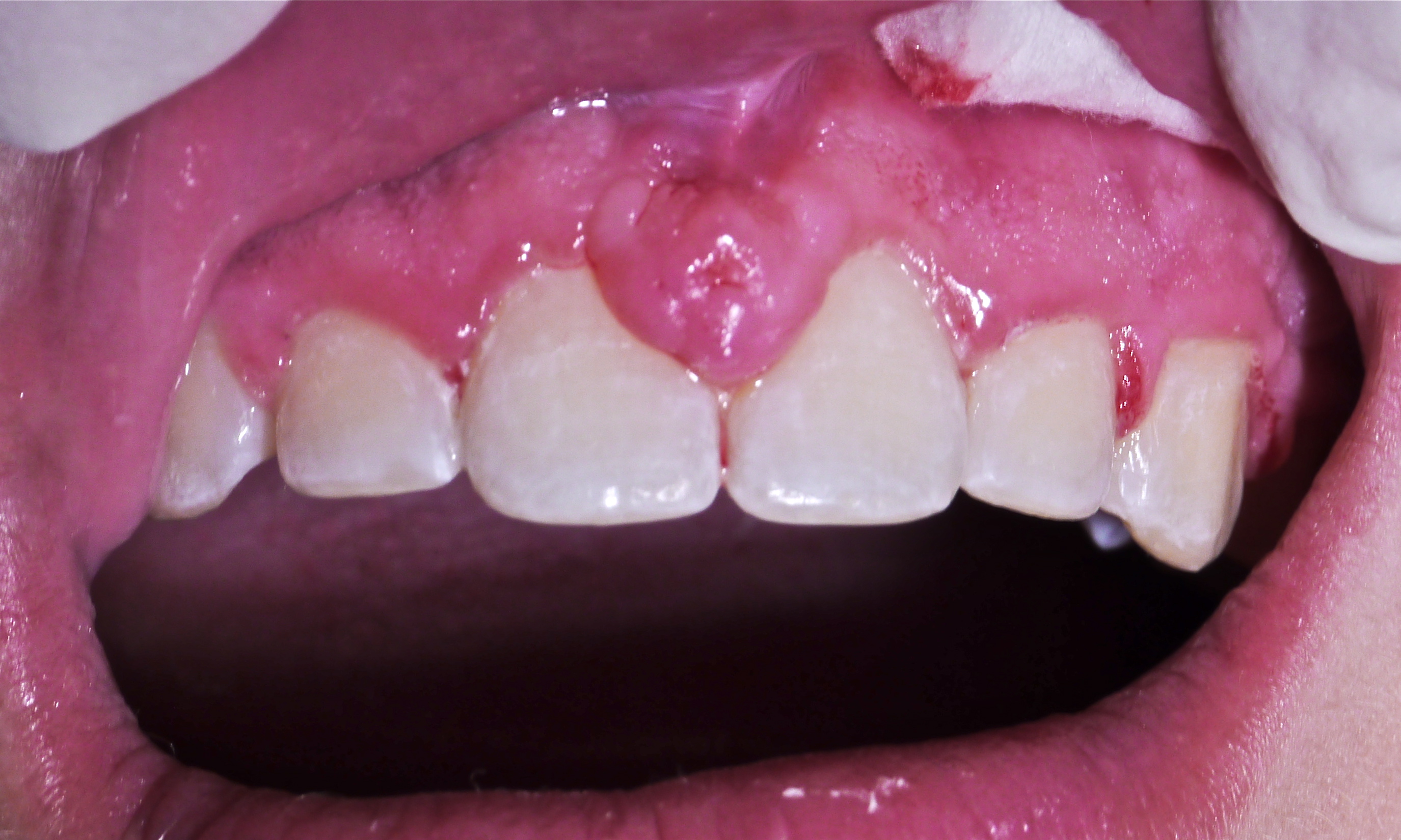 Gum Reshaping And Contouring In Vadodaramonarch Dental Clinic
